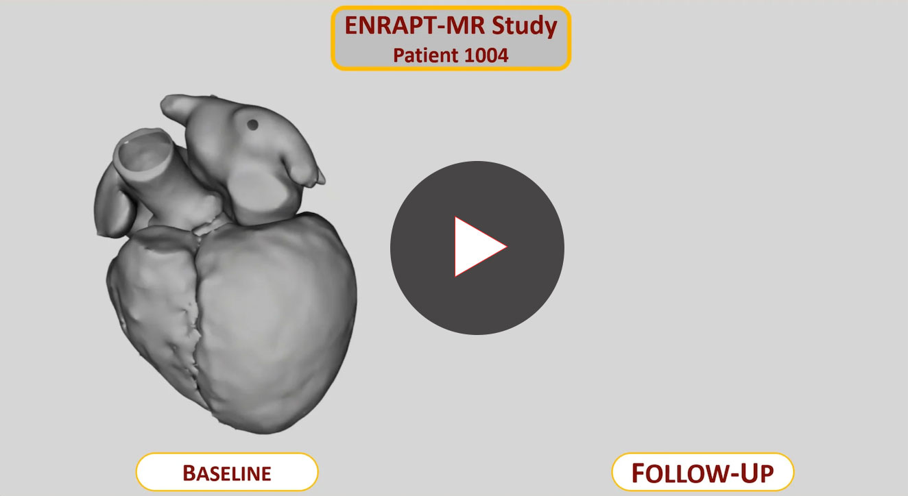 Structural Heart Treatment Meets Structural Heart Imaging: Mitre ...